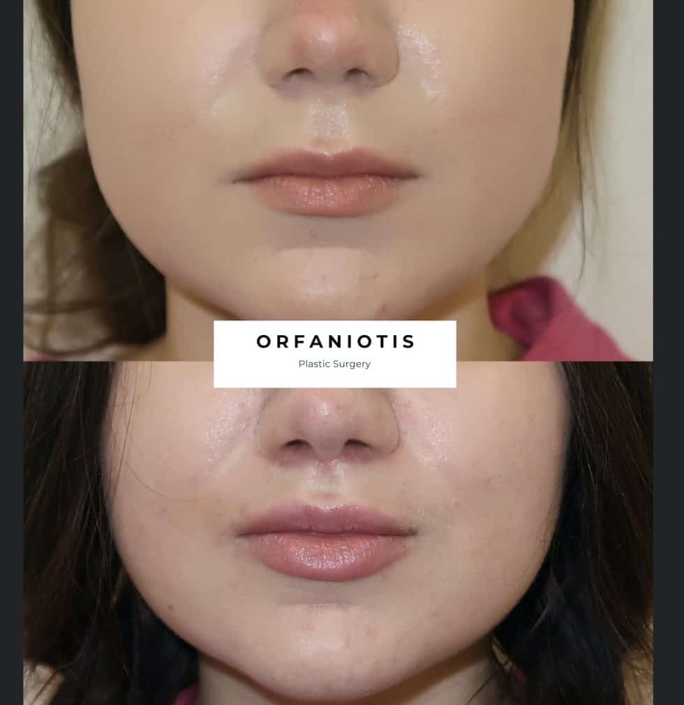 Lip Lift Surgery in London: Rejuvenating the Lower Face