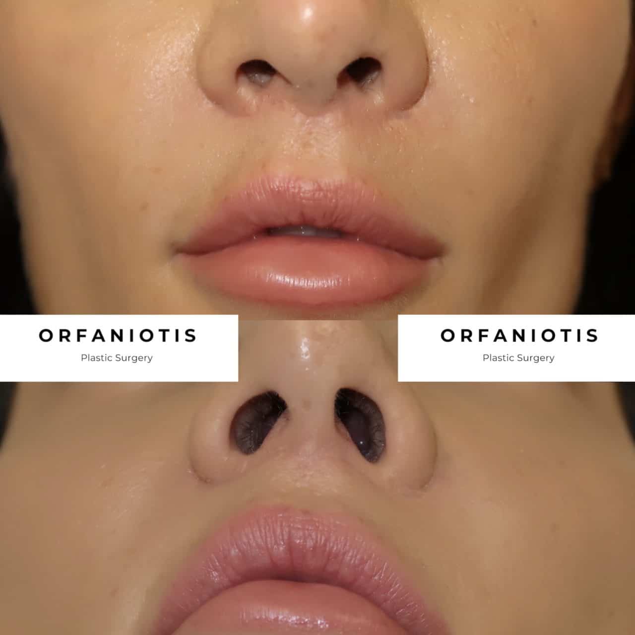 Lip Lift Surgery in London: Rejuvenating the Lower Face