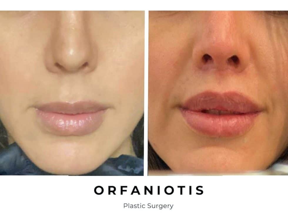 Lip Lift Surgery in London: Rejuvenating the Lower Face